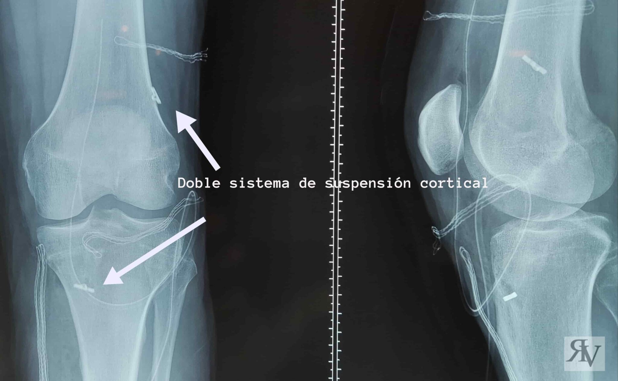 Reconstrucción de ligamento cruzado anterior con técnica all inside ...