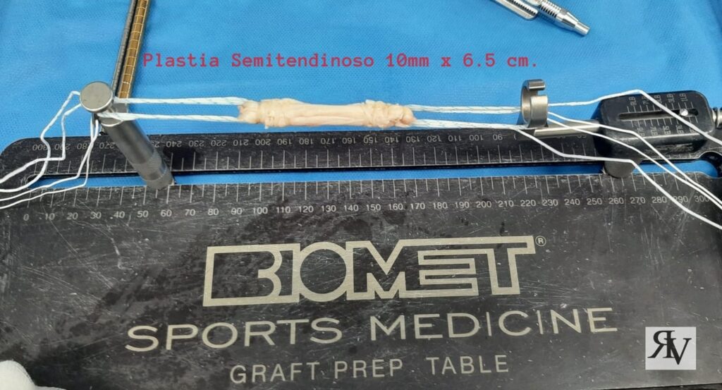 Reconstrucción de ligamento cruzado anterior con técnica all inside ...